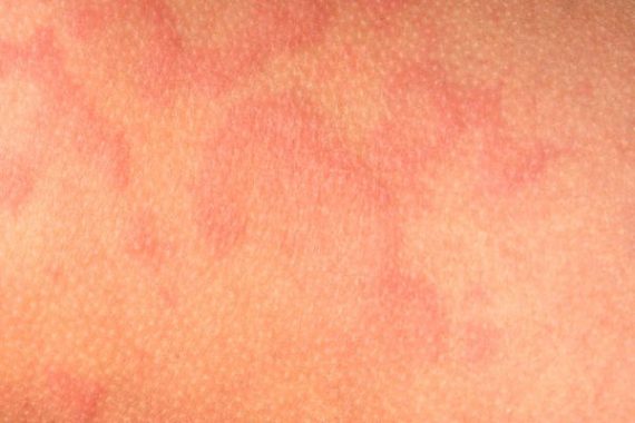 Alergia al sol: 5 tipos de fotodermatosis más comunes