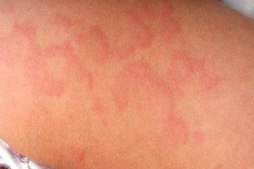 Información sobre Edema en piernas hinchadas | IML
