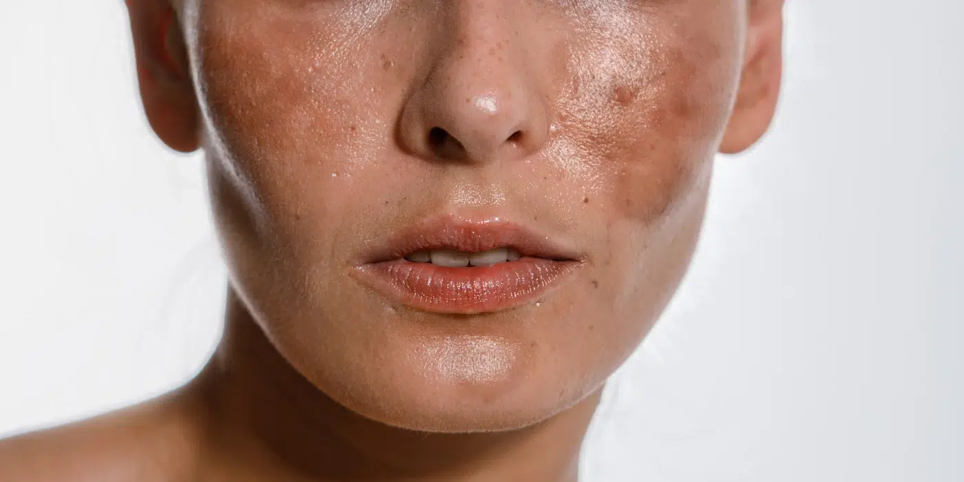 ¿Qué es melasma? Todo lo que debes saber | IML Clinic
